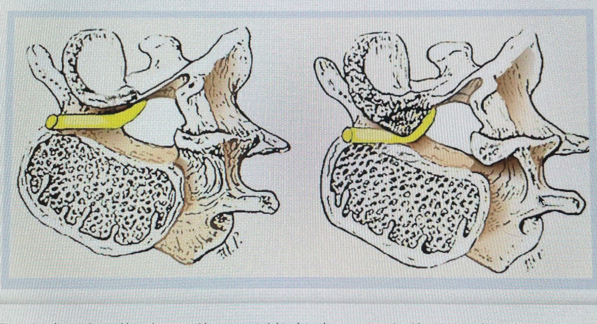 Lateral Recess Stenosis | NSPC Brain & Spine Surgery
