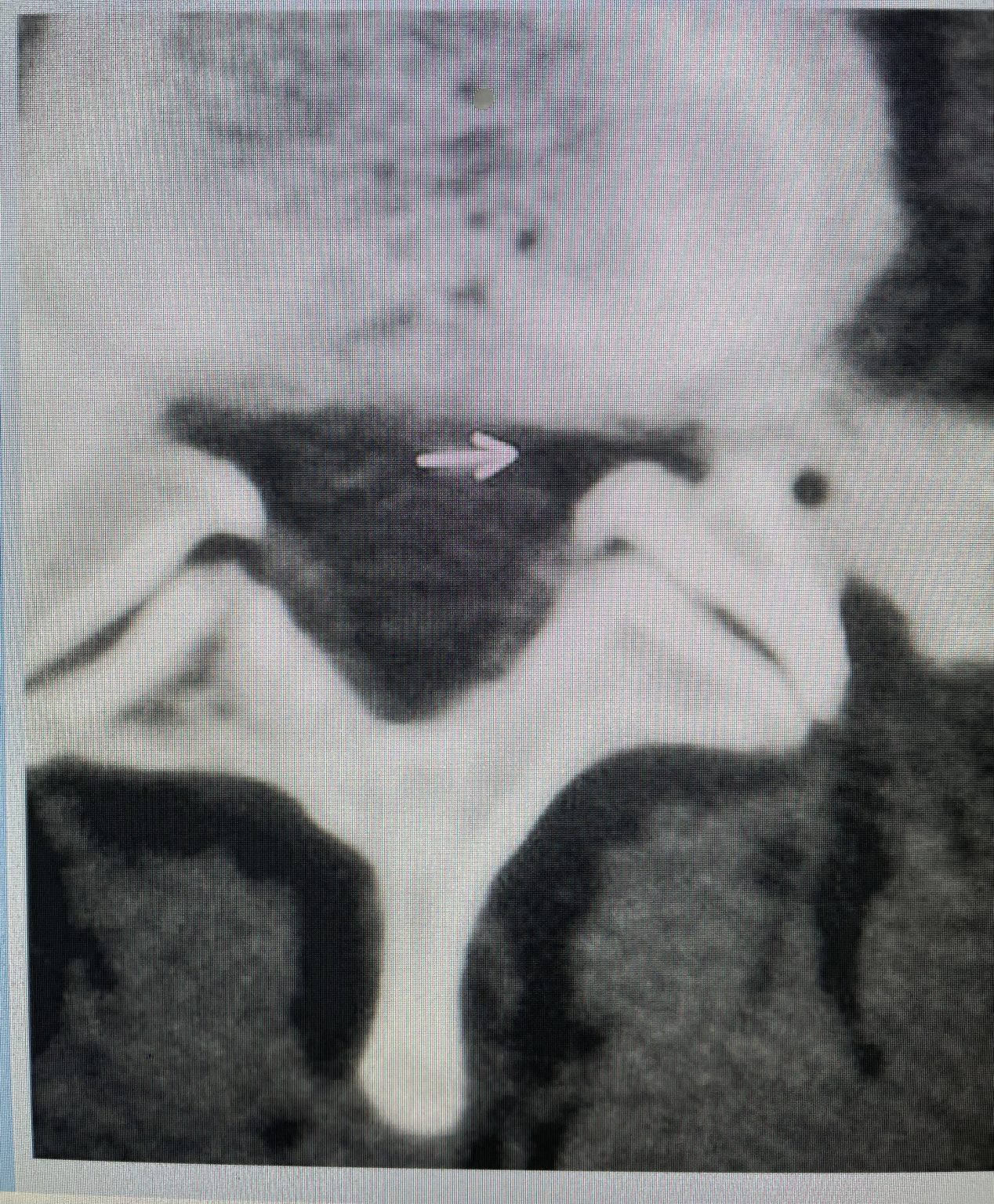 Lateral Recess Stenosis | NSPC Brain & Spine Surgery