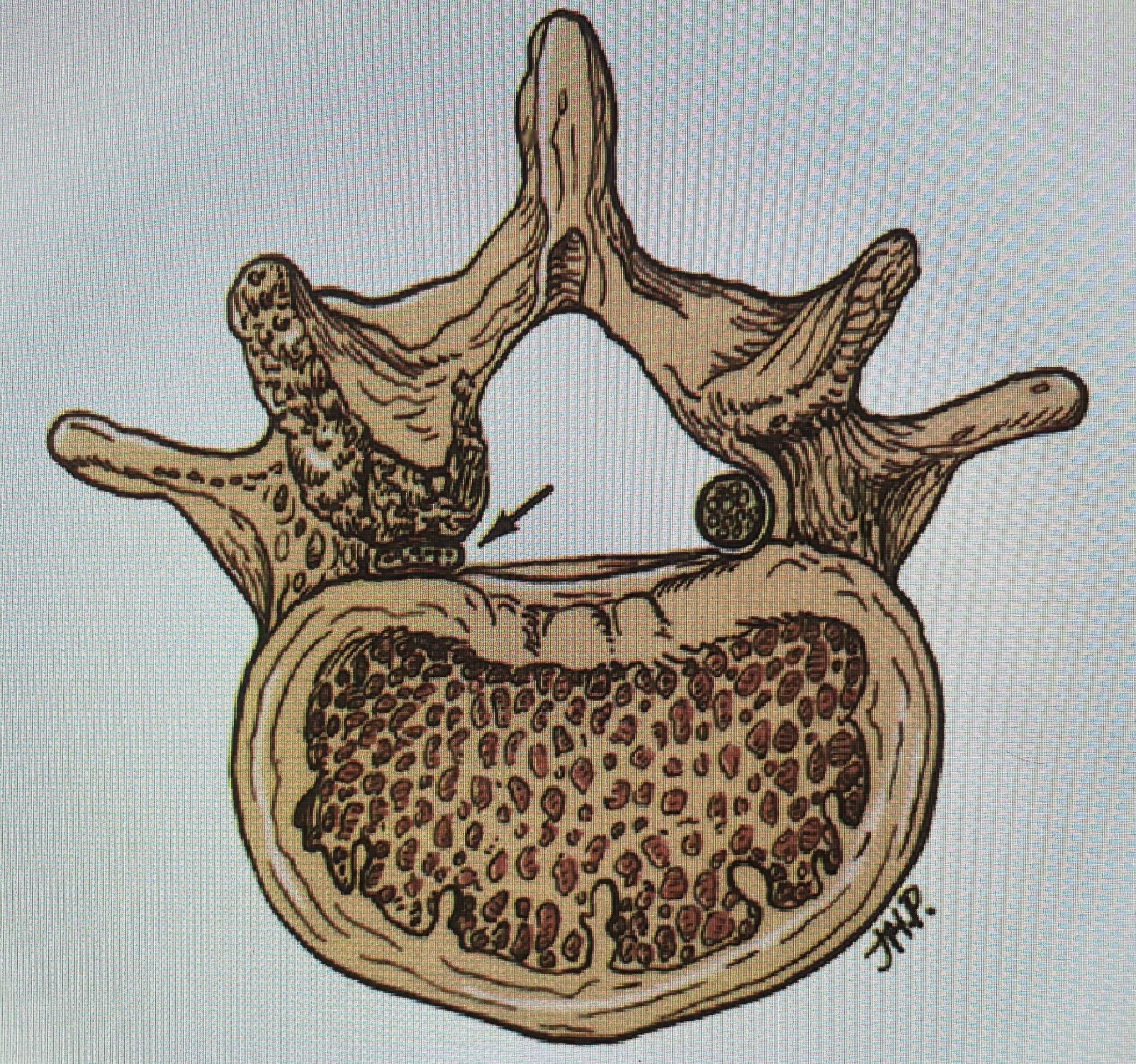 Lateral Recess Stenosis | NSPC Brain & Spine Surgery