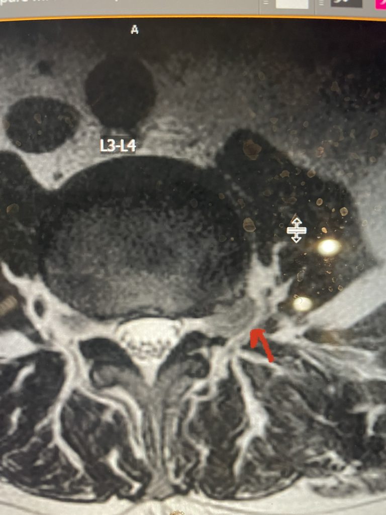 Lateral Disc Herniations | NSPC Brain & Spine Surgery