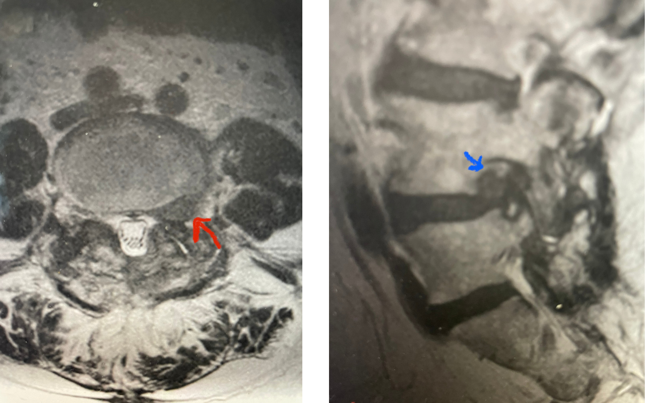 Lateral Disc Herniations | NSPC Brain & Spine Surgery