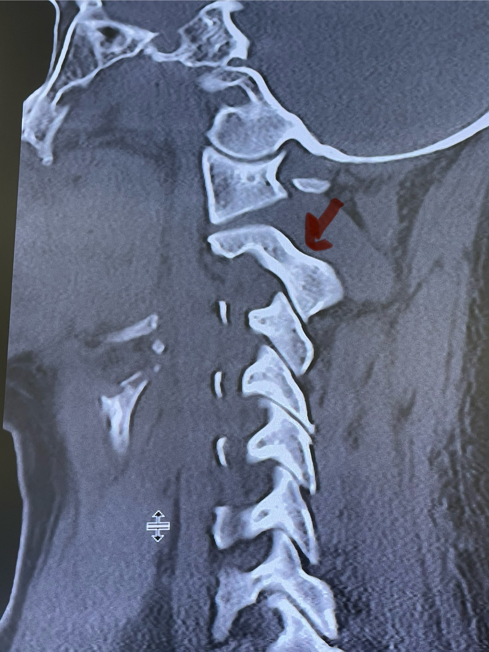 SOMETIMES YOU HAVE TO CONNECT THE SKULL TO THE NECK | NSPC Brain ...